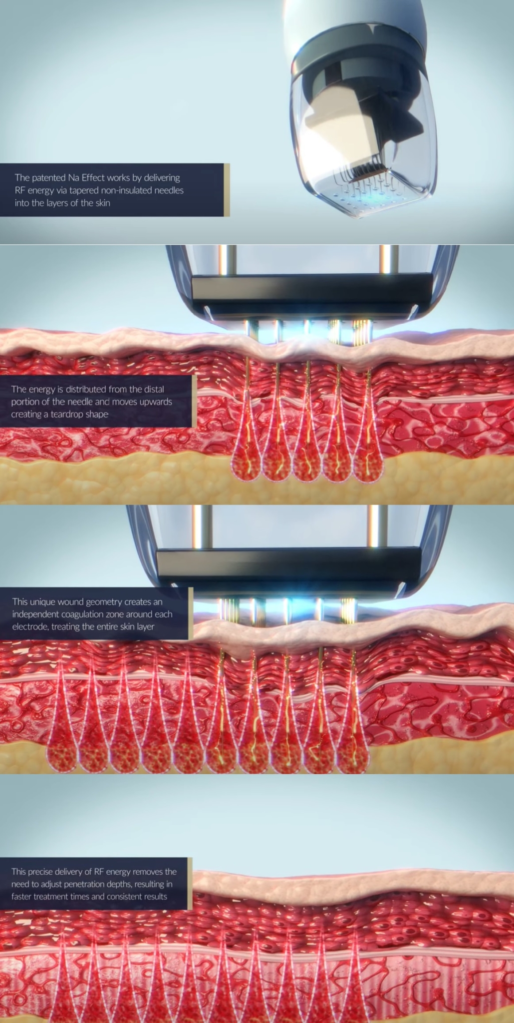 Scarlet RF Microneedling | Salem & Tigard OR