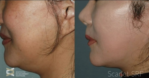Scarlet RF Microneedling | Salem & Tigard OR
